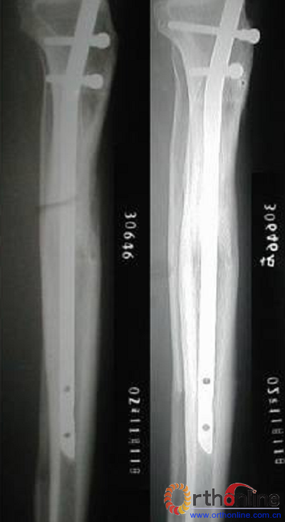 Tibial lengthening over an intramedullary nail in patients with short ...