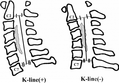 颈椎后纵韧带骨化症 ——隐蔽的杀手 | 骨科在线