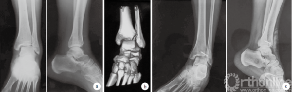 累及Tillaux-Chaput骨块的成人踝关节骨折临床特点及手术疗效 | 骨科在线