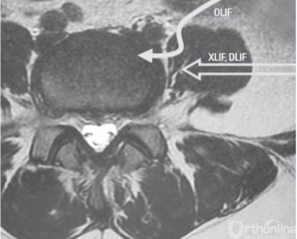XLIF/OLIF的并发症及解剖型cage的初步临床应用 | 骨科在线