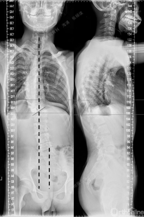 选择性半椎体切除治疗多发性半椎体先天性脊柱侧凸的临床经验分享 | 骨科在线