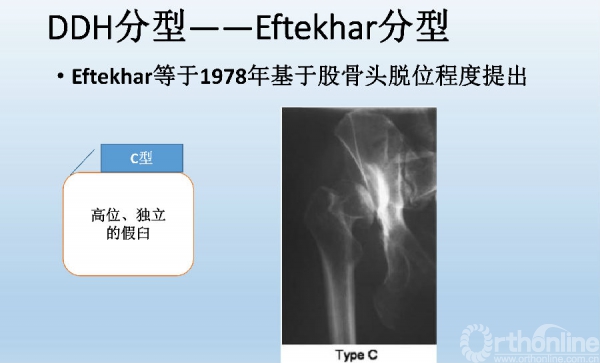 钱文伟：全面解析成人发育性髋关节脱位（DDH）分型 | 骨科在线