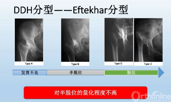 钱文伟：全面解析成人发育性髋关节脱位（DDH）分型 | 骨科在线