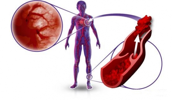 骨科患者VTE的筛查与预防 | 骨科在线