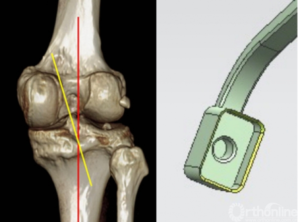 全关节镜下胫骨Inlay技术重建PCL | 骨科在线