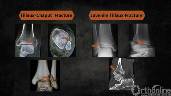 踝关节特殊骨 折之Wagstaffe与Tillaux-chaput骨折 | 骨科在线
