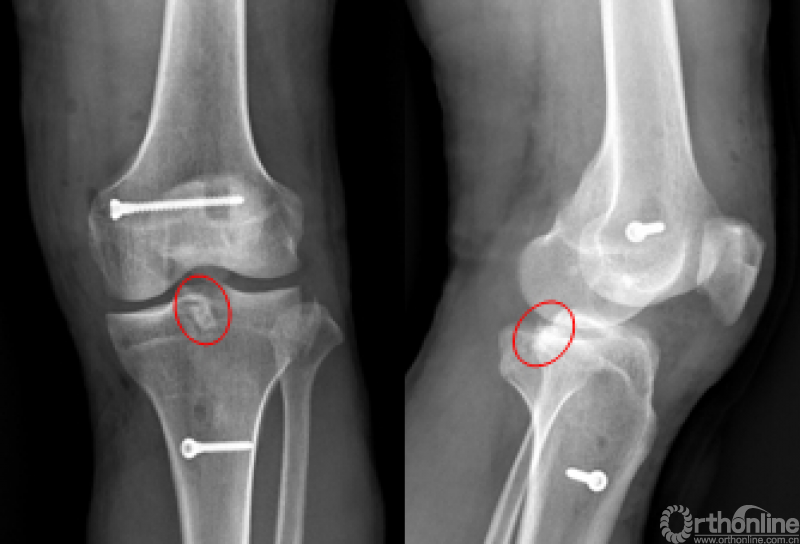 全关节镜下胫骨Inlay技术重建PCL | 骨科在线