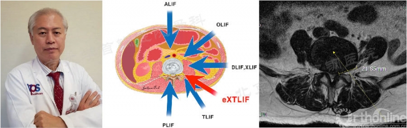 UBE/BESS下腰椎融合术的种类、溯源及对比（上） | 骨科在线