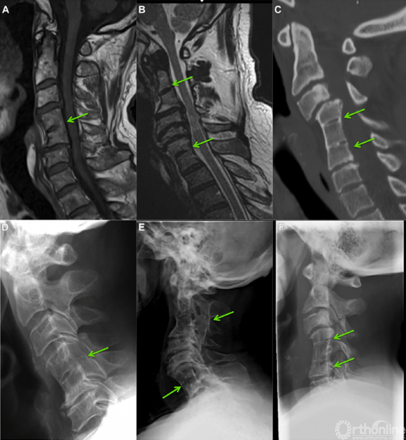 Klippel-Feil综合征影像学分型指导对手术治疗的研究进展 | 骨科在线