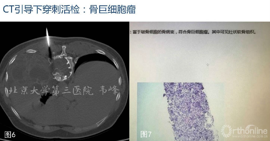 【奇案求真】这例胸椎巨大骨巨细胞瘤是如何切除并固定椎体的？ | 骨科在线