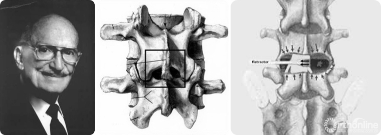 知史识今，传承创新——腰椎间融合术演义（第三回） | 骨科在线