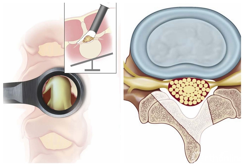 一步步做好通道下腰椎管狭窄微创减压术 | 骨科在线