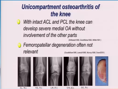 保膝讲坛|国际保膝大师Lobenhoffer教授为您传授UKA适应证选择中的技巧 | 骨科在线