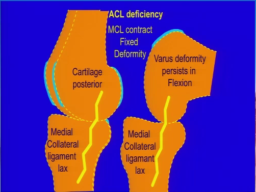 保膝讲坛|国际保膝大师Lobenhoffer教授为您传授UKA适应证选择中的技巧 | 骨科在线