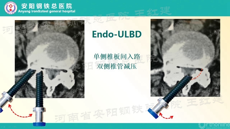 Endo-ULBD技术治疗腰椎管狭窄症的价值和边界 | 骨科在线