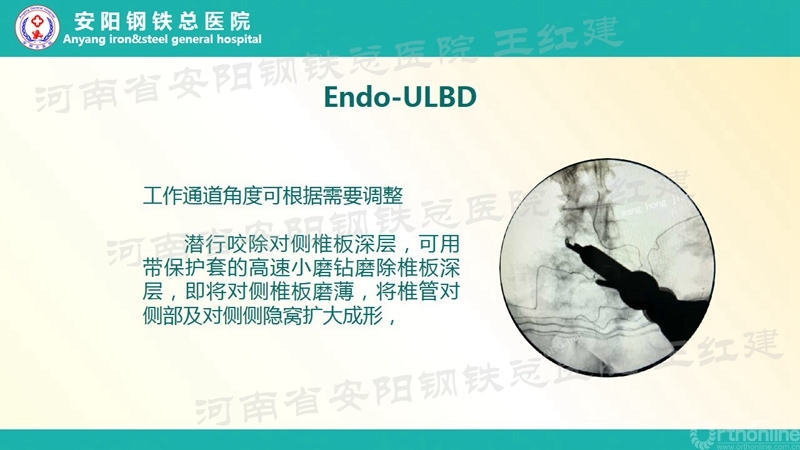 病例赏析|Endo-ULBD技术治疗腰椎管狭窄症 | 骨科在线