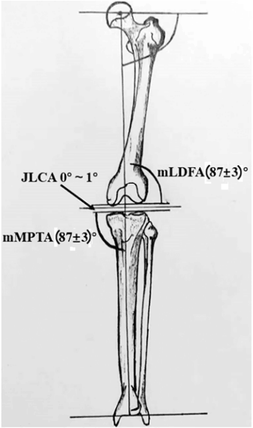 骨科手术技术|股骨和胫骨双部位截骨治疗复杂膝关节冠状位内翻畸形 | 骨科在线