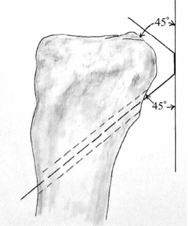 关节镜下后交叉韧带单束重建手术要点 | 骨科在线