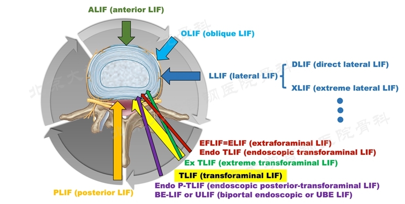 UBE/BESS下腰椎融合术的种类、溯源及对比（上） | 骨科在线