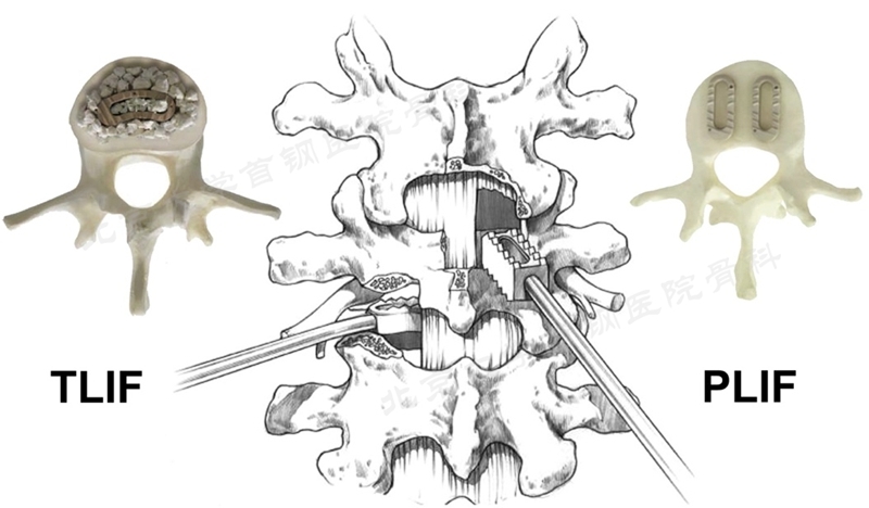 UBE/BESS下腰椎融合术的种类、溯源及对比（上） | 骨科在线