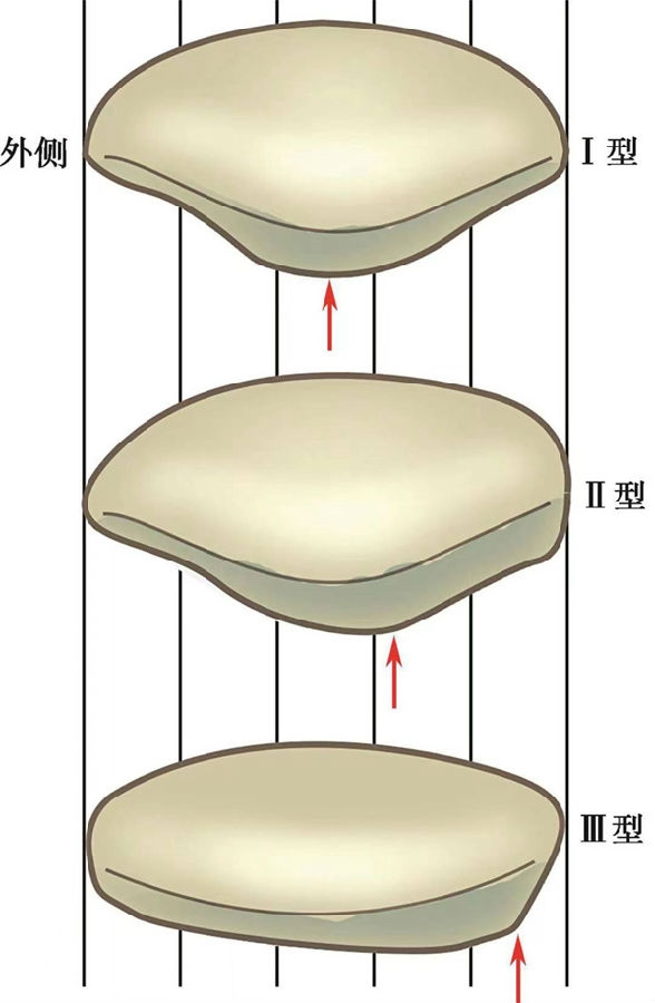 髌股关节轴位影像学表现 | 骨科在线