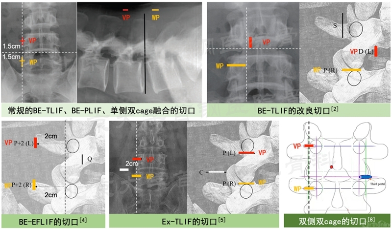 UBE/BESS下腰椎融合术的种类、溯源及对比（下） | 骨科在线