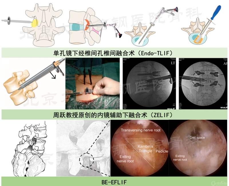 UBE/BESS下腰椎融合术的种类、溯源及对比（下） | 骨科在线