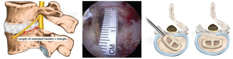 UBE/BESS下腰椎融合术的种类、溯源及对比（下） | 骨科在线