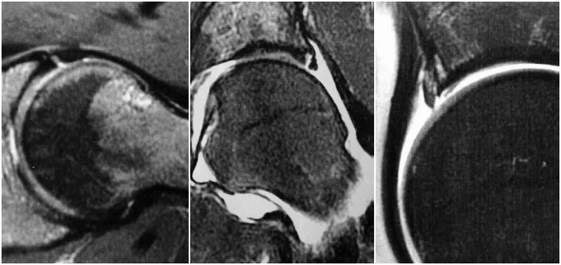 全面掌握髋关节撞击综合征的诊断与治疗 | 骨科在线