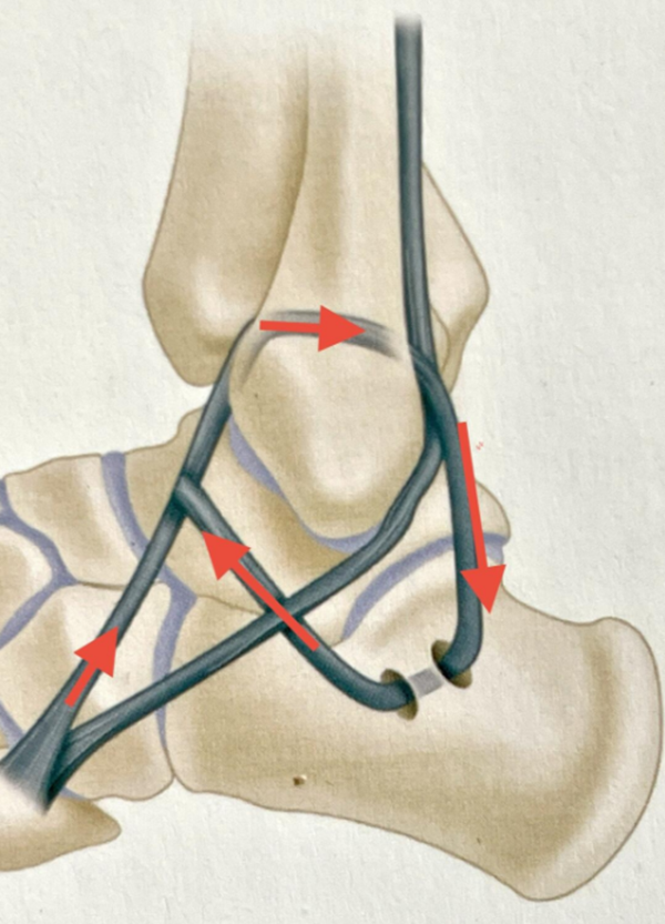 踝关节外侧韧带损伤临床病例报告 | 骨科在线