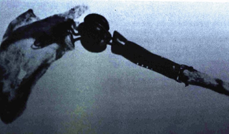 反式肩关节置换的前世今生 | 骨科在线