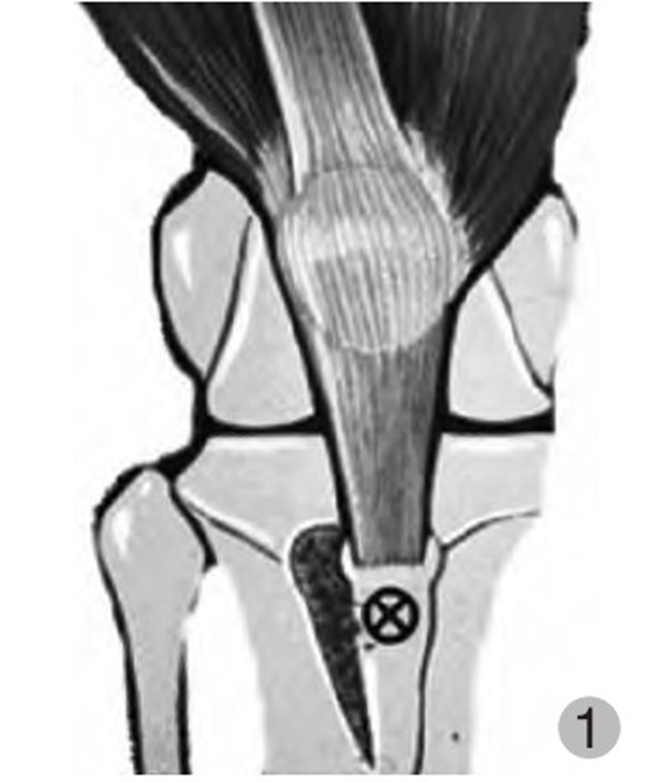 髌股关节不稳定的截骨治疗 | 骨科在线