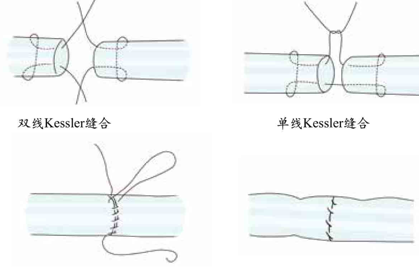 骨科基础 | 皮下及肌腱常见缝合方法 | 骨科在线