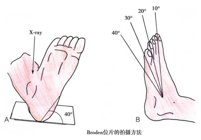 图文详解 | 跟骨骨折的损伤机制和分型 | 骨科在线
