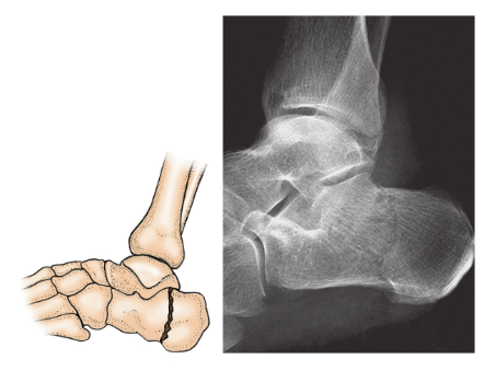图文详解 | 跟骨骨折的损伤机制和分型 | 骨科在线