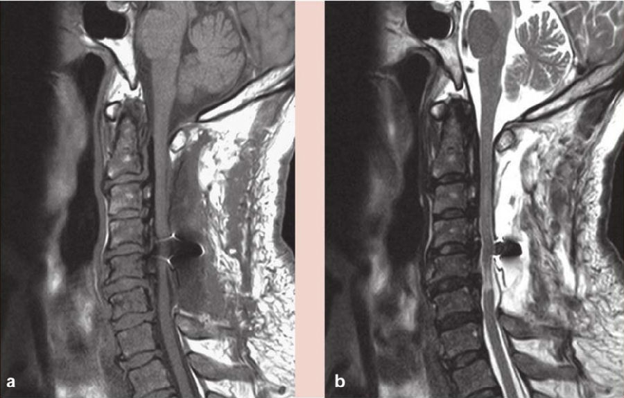 病例分享：C2-C6颈椎管狭窄（OPLL） | 骨科在线